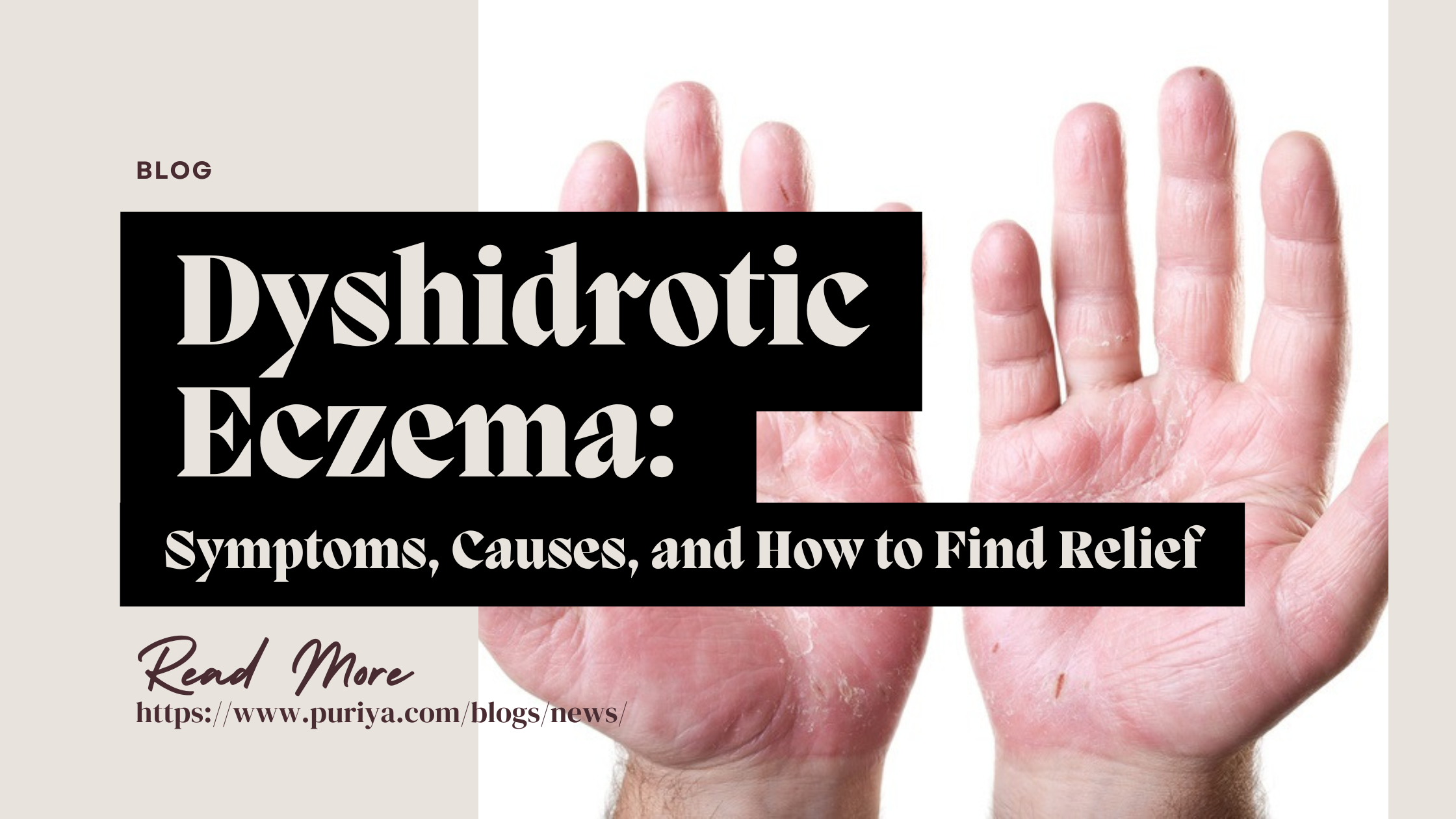 Dyshidrotic Eczema: Symptoms, Causes, and How to Find Relief – Puriya