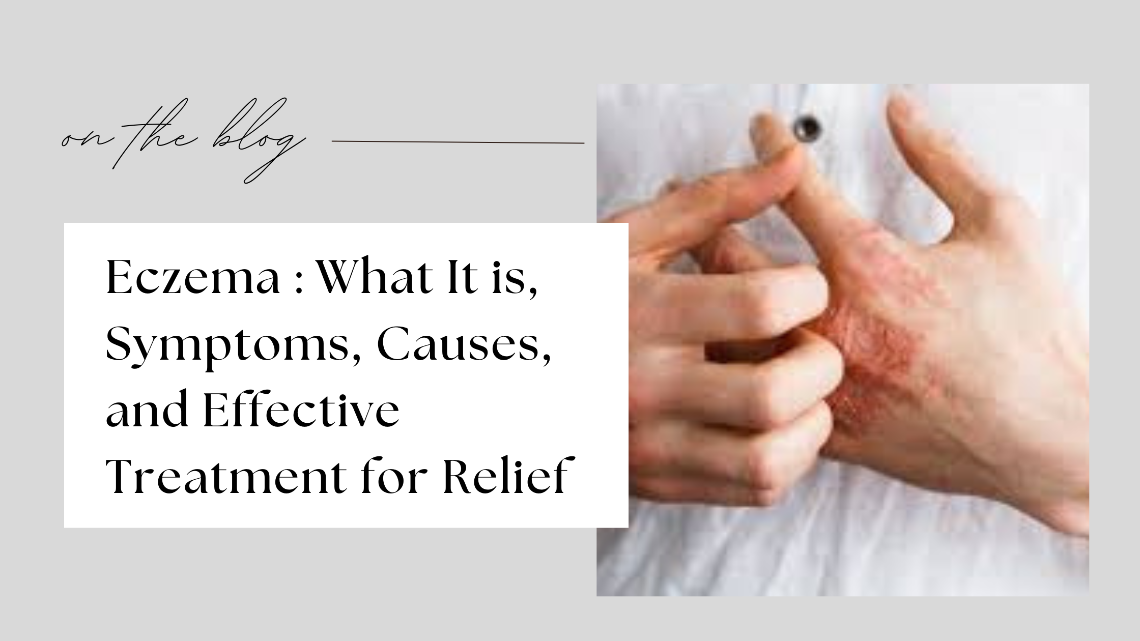 Eczema: What It is, Symptoms, Causes and Effective Treatment – Puriya