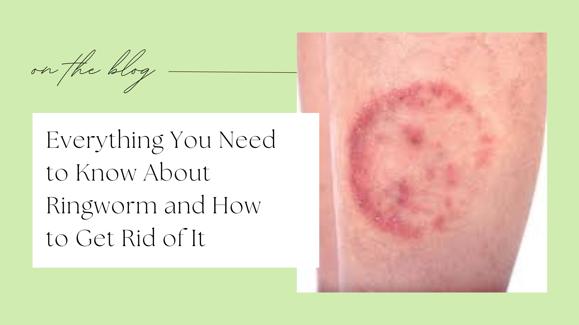 Everything You Need to Know About Ringworm and How to Get Rid of It ...