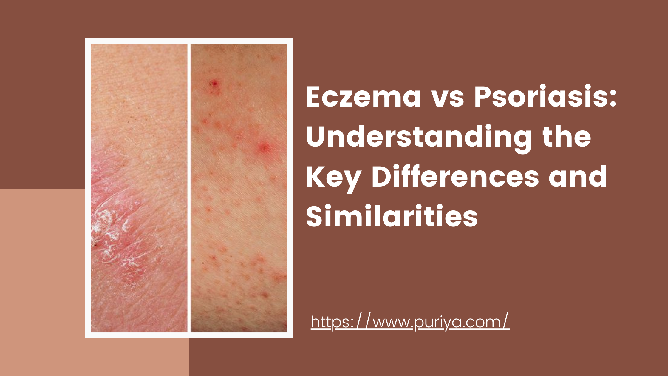 Eczema vs Psoriasis: Understanding the Key Differences – Puriya