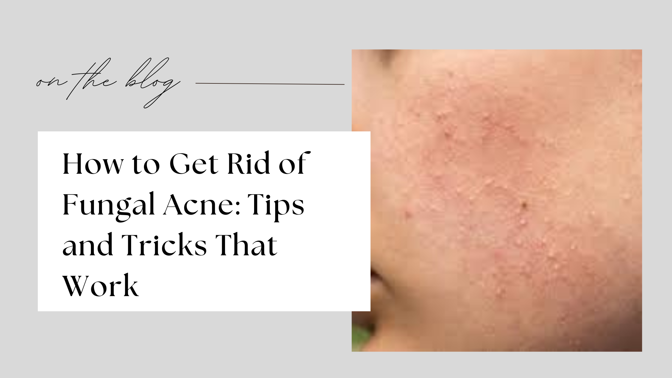 How to Get Rid of Fungal Acne: Tips and Tricks That Work – Puriya