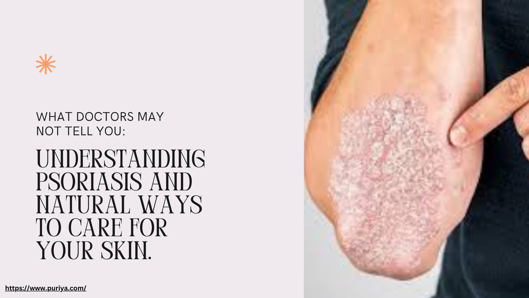 What Doctors May Not Tell You: Understanding Psoriasis and Natural Ways ...
